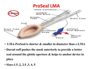 supraglottic airway devices | PPTX