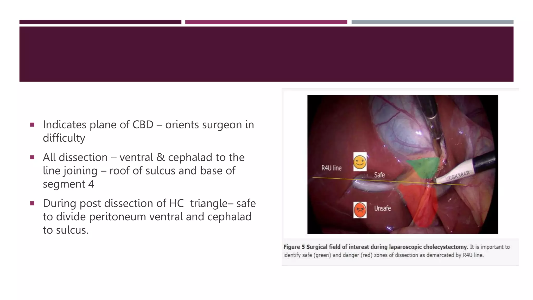 Safe cholecystectomy.pptx