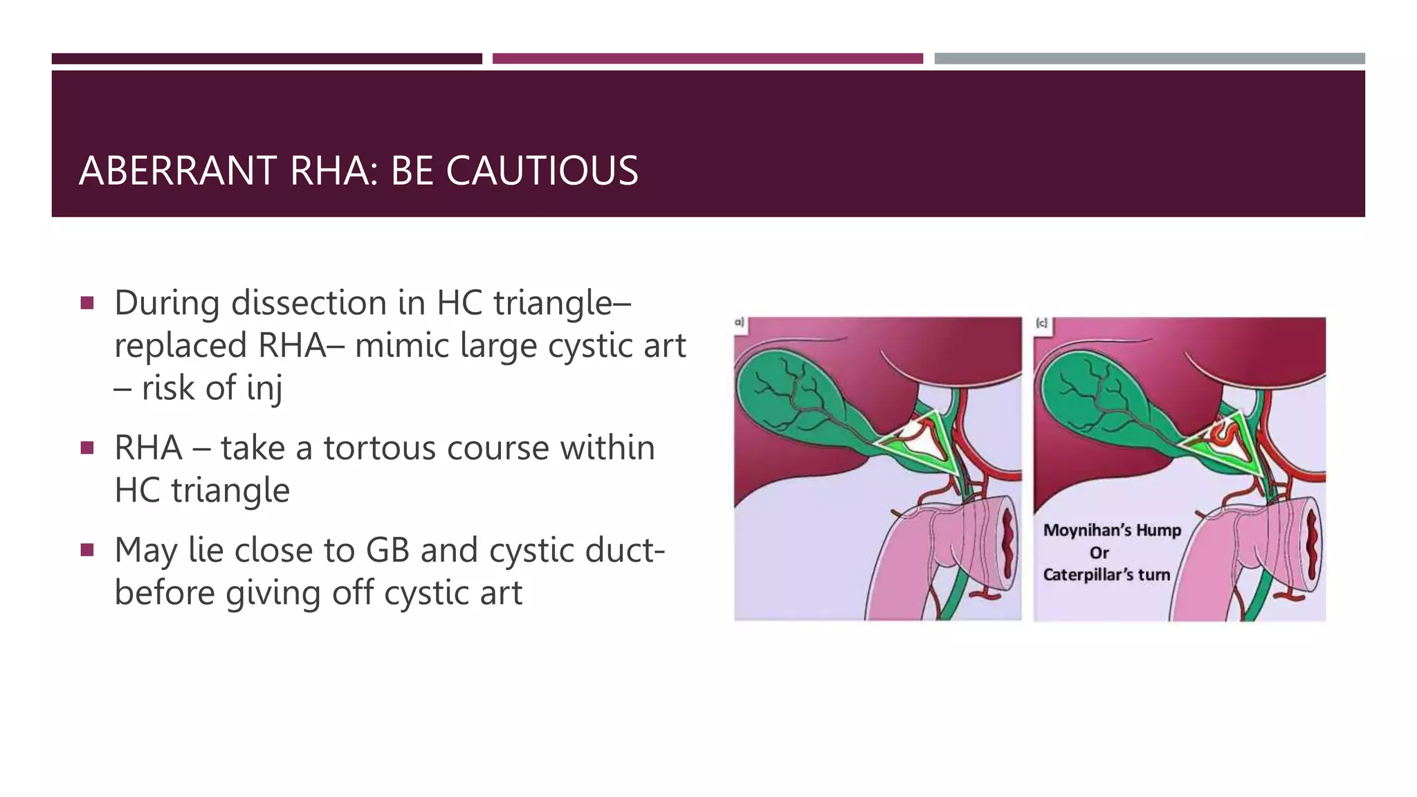 Safe cholecystectomy.pptx