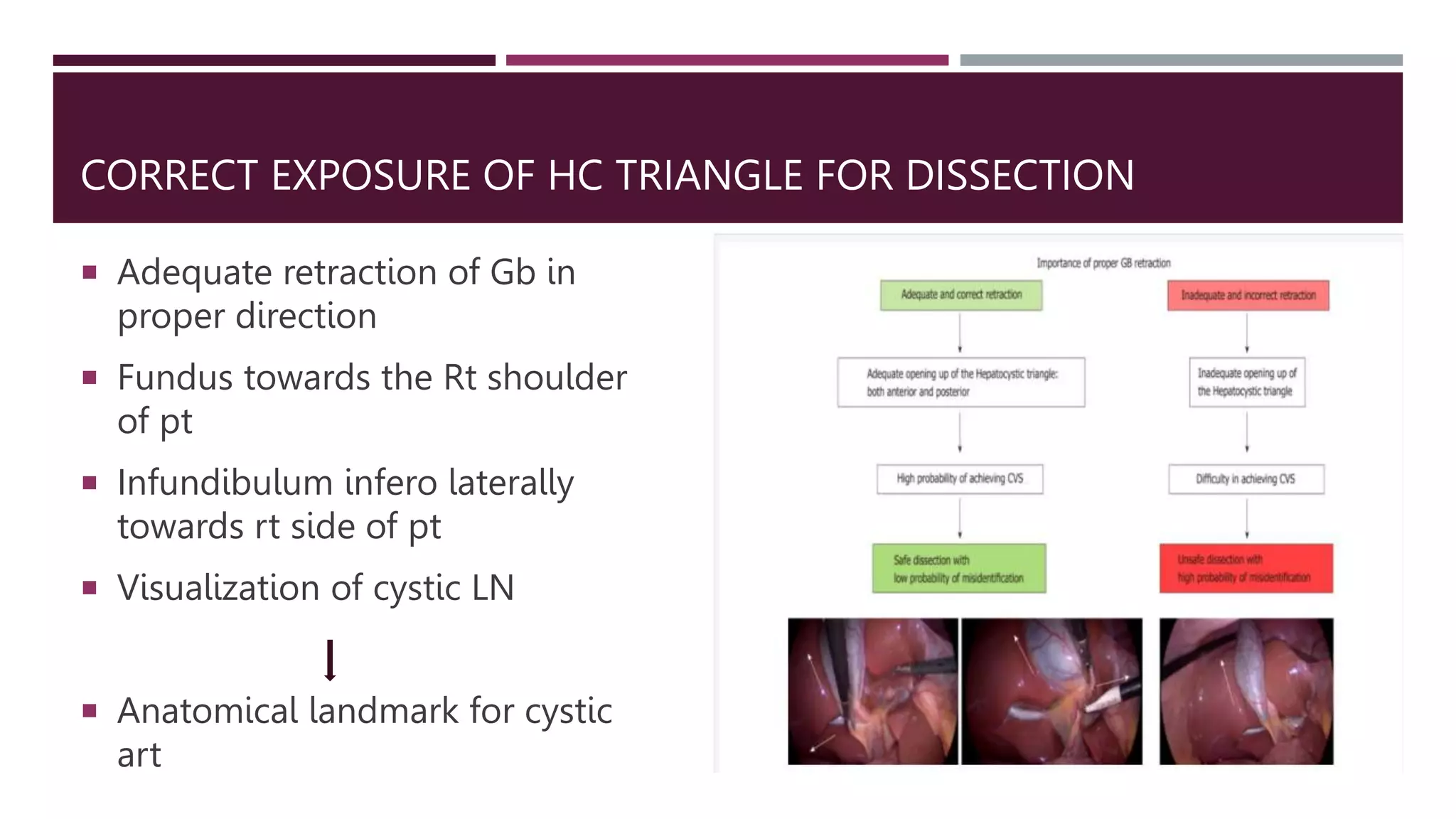 Safe cholecystectomy.pptx