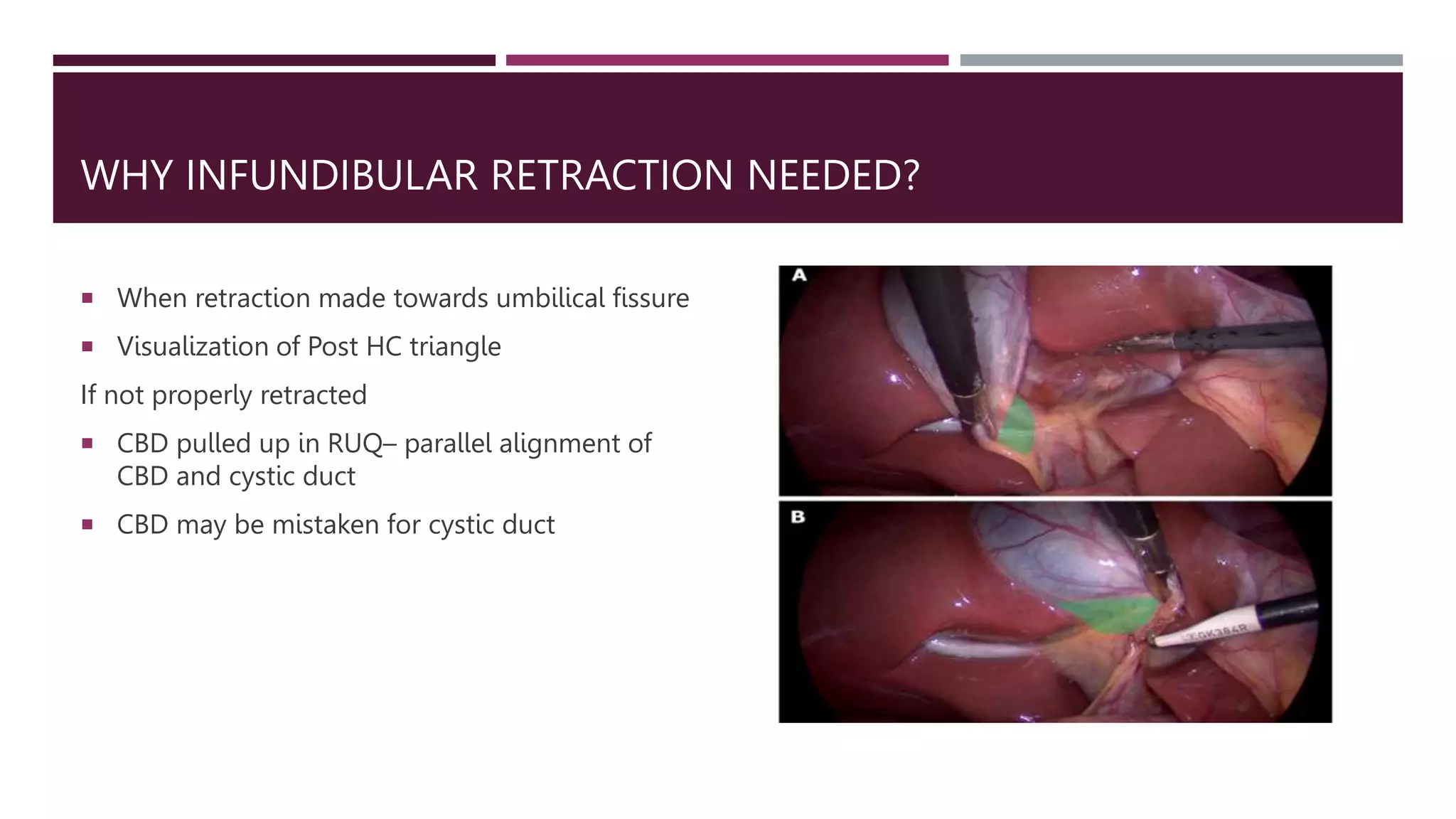 Safe cholecystectomy.pptx
