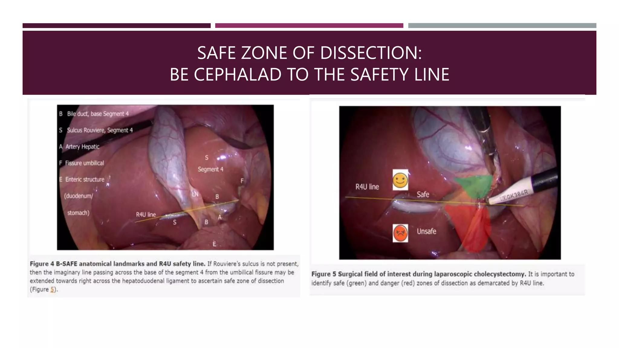Safe cholecystectomy.pptx