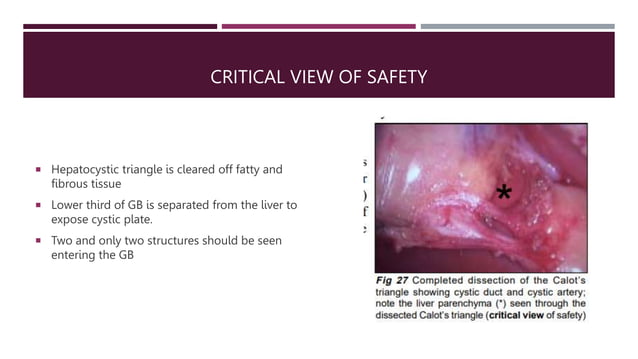 Safe cholecystectomy.pptx | Digestive Disorders | Diseases and Conditions