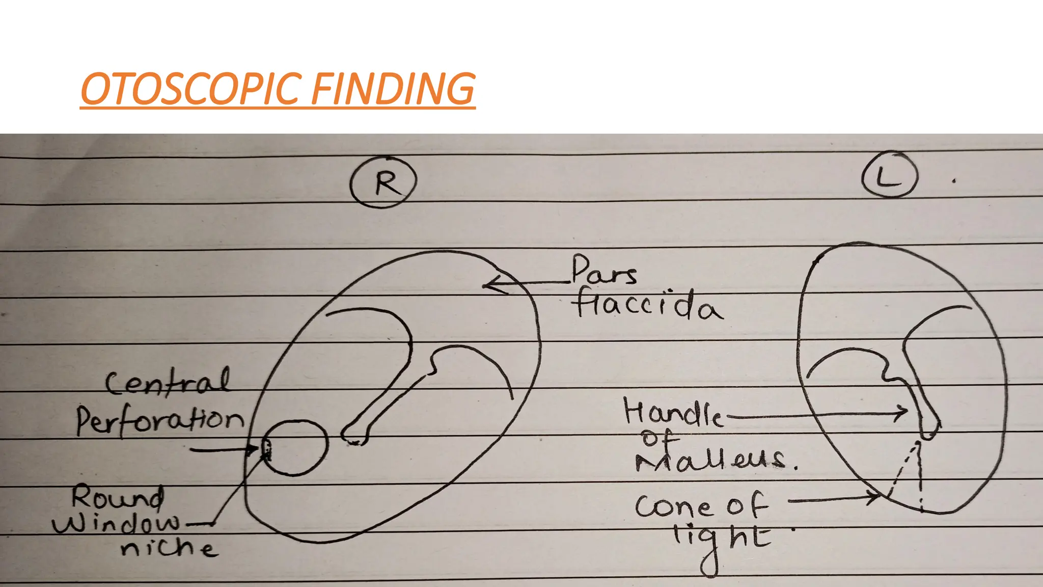 SAFE Chronic Serous Otitis Media (CSOM) MBBS ENT .pptx