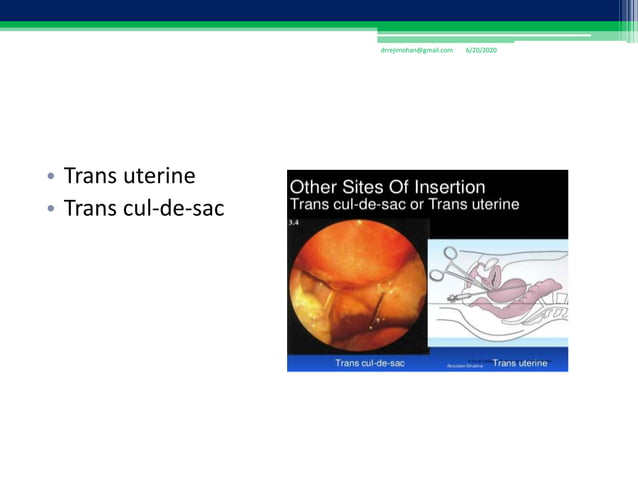 Safe entry in gyn endoscopy | PPT