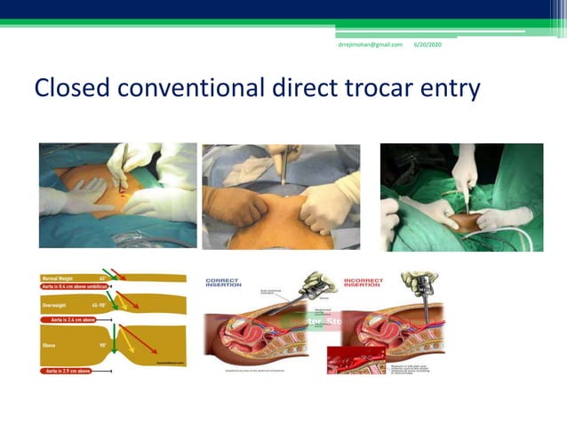 Safe entry in gyn endoscopy | PPT