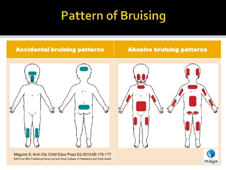 Accidently Vs Accidentally
