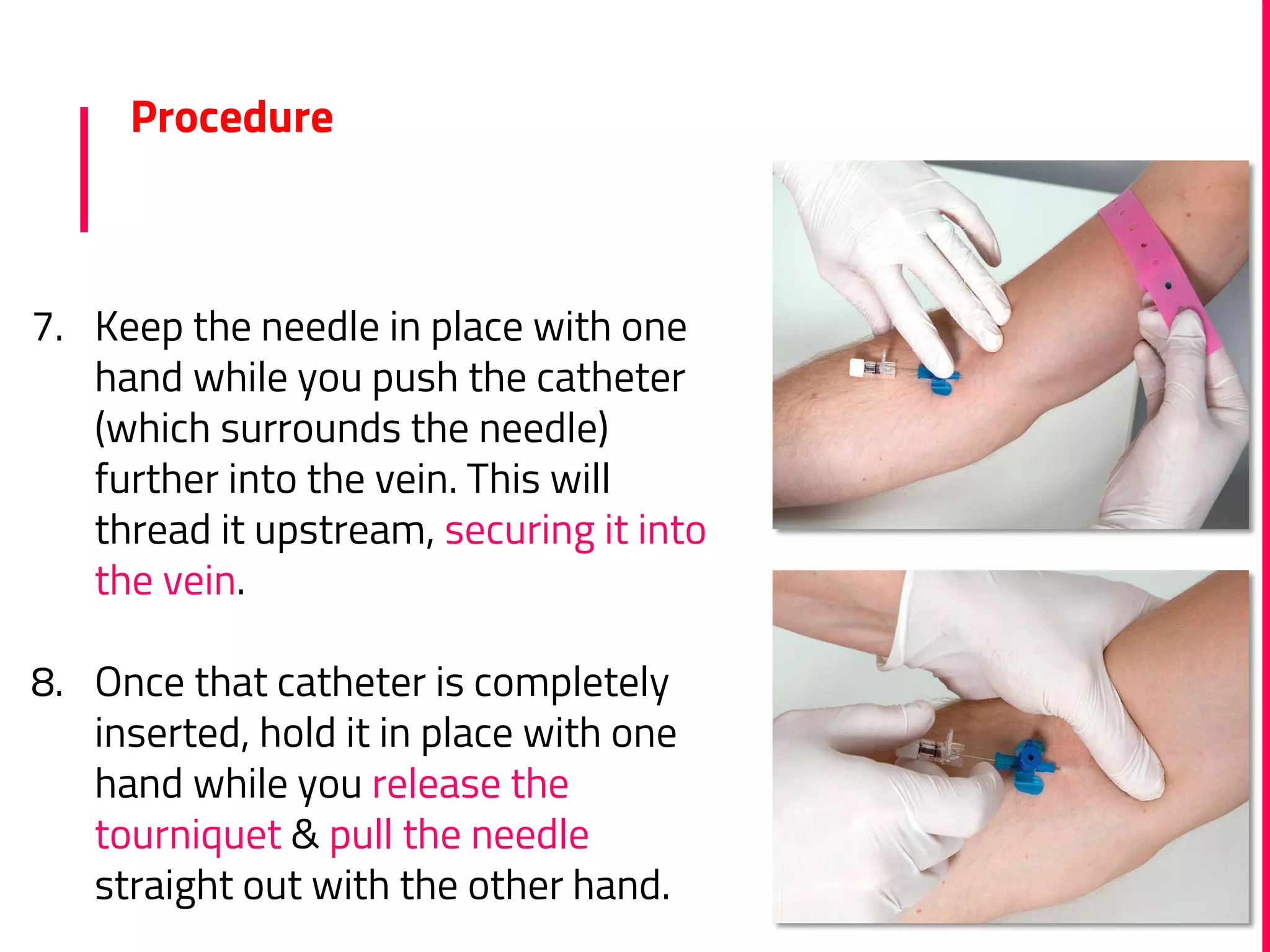 Safe iv cannulation (prevention of iv thrombophlebitis) | PDF