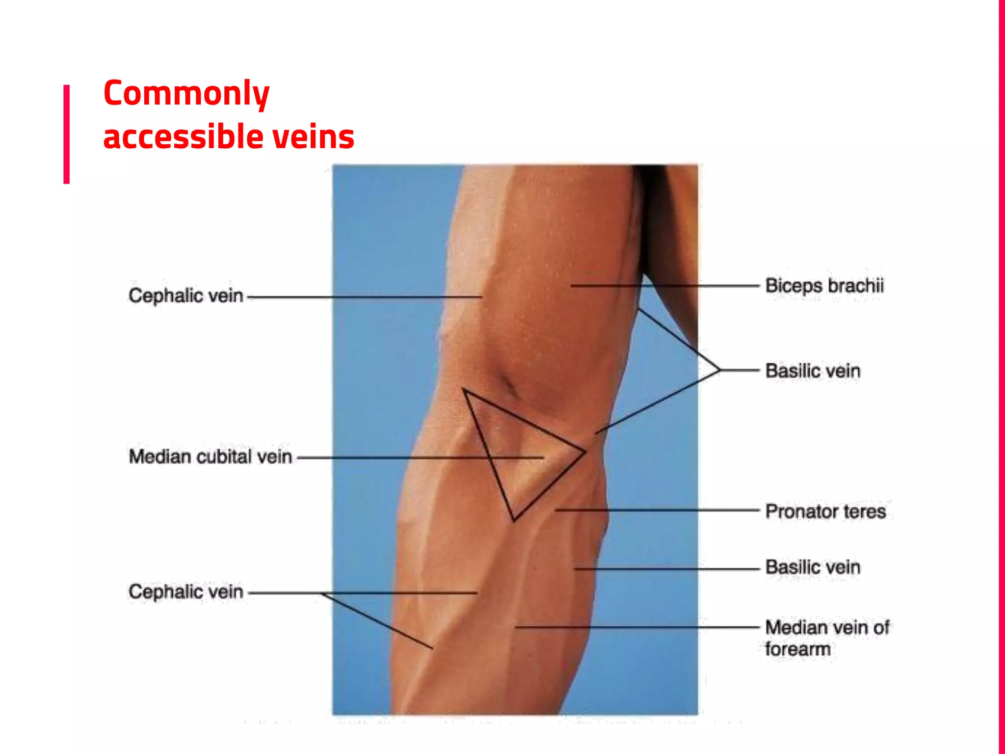 Safe iv cannulation (prevention of iv thrombophlebitis) | PDF