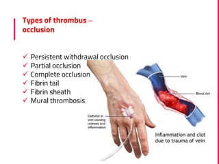 Safe iv cannulation (prevention of iv thrombophlebitis) | PDF