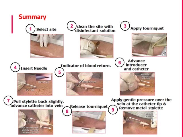 Safe iv cannulation (prevention of iv thrombophlebitis)
