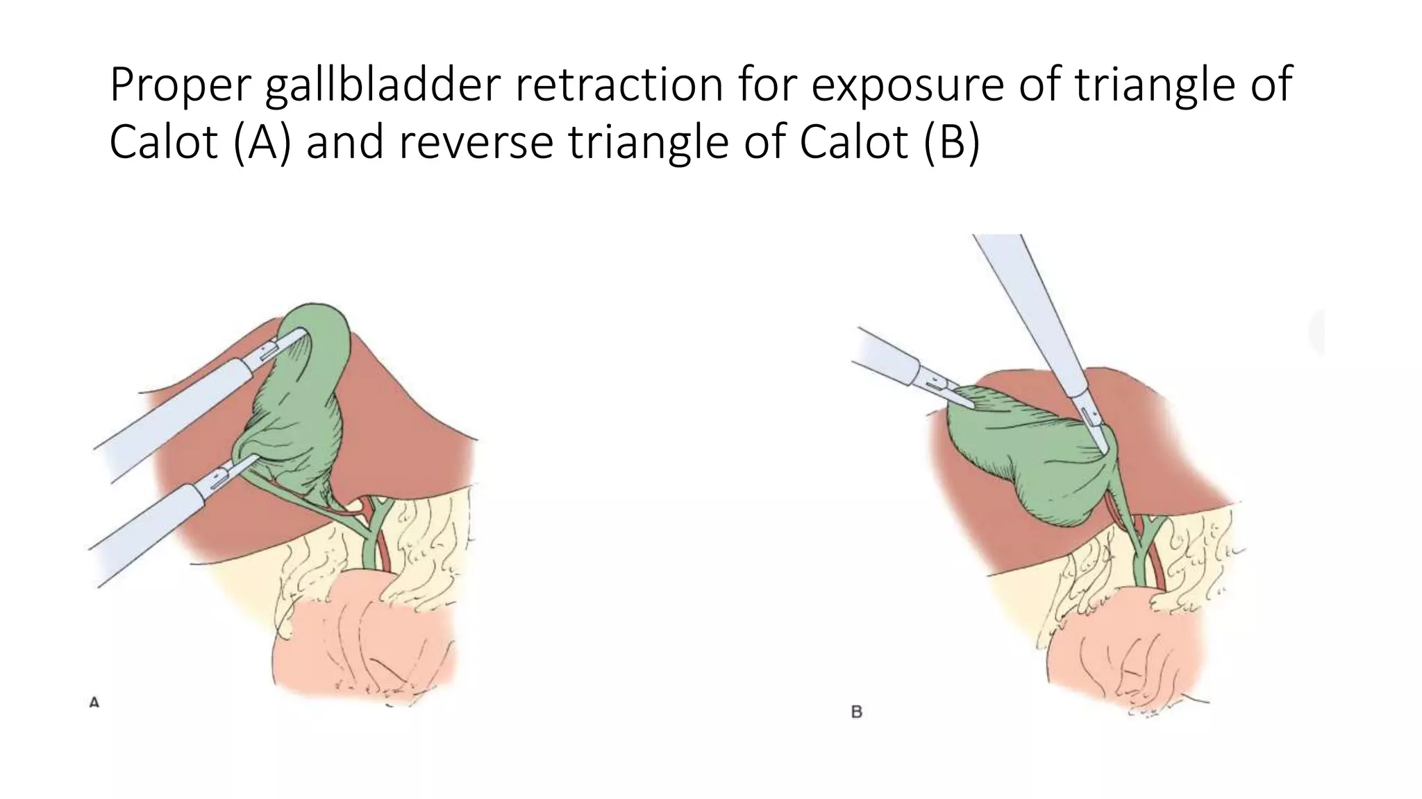 SAFE LAPAROSCOPIC CHOLECYSTECTOMY | PPTX