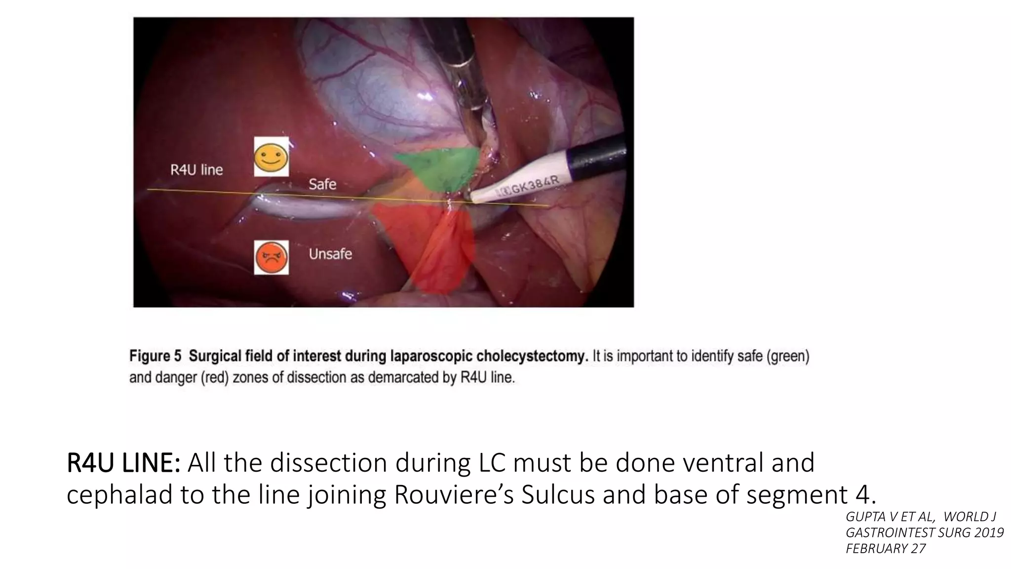 SAFE LAPAROSCOPIC CHOLECYSTECTOMY | PPTX