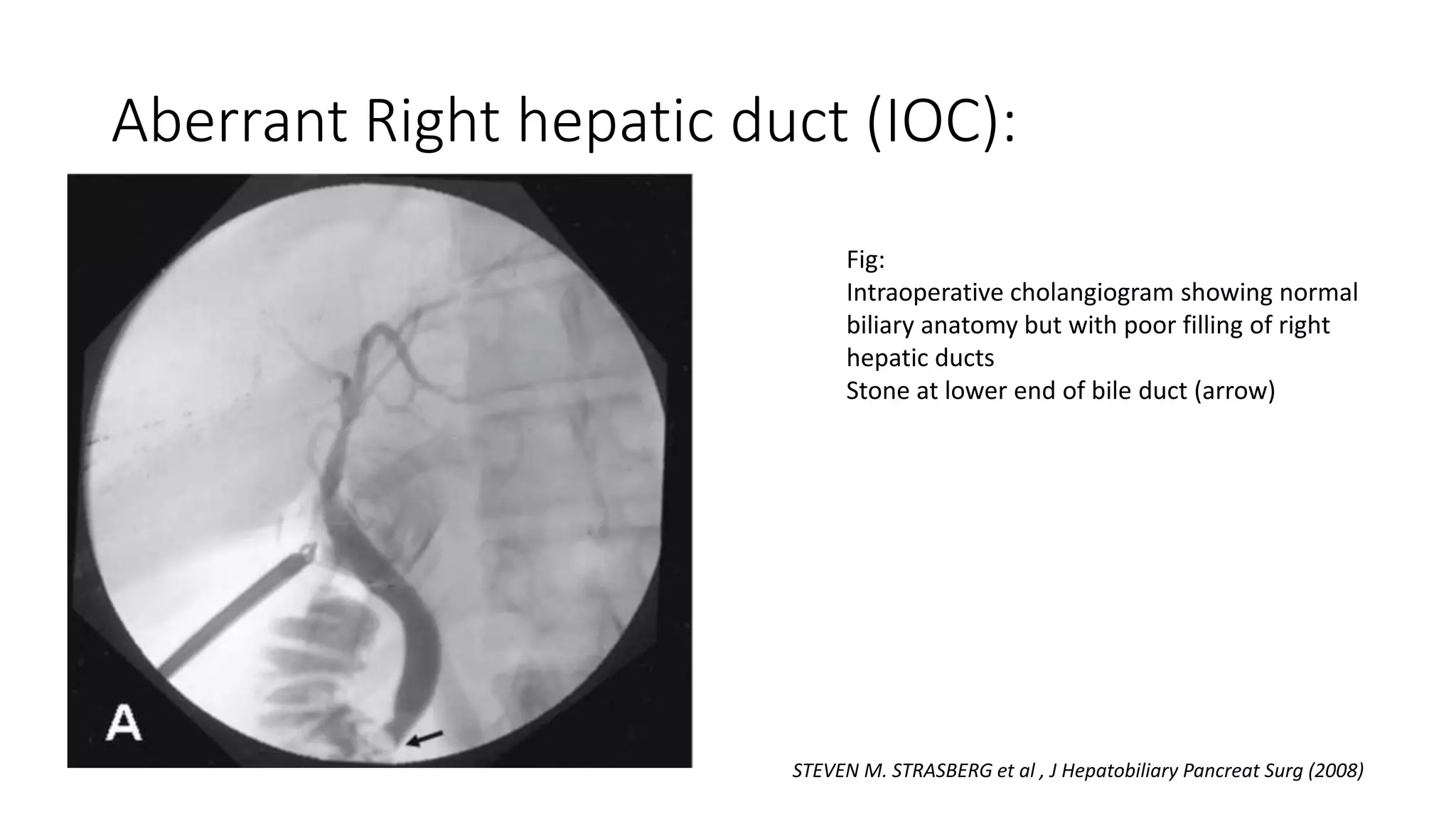 SAFE LAPAROSCOPIC CHOLECYSTECTOMY | PPTX