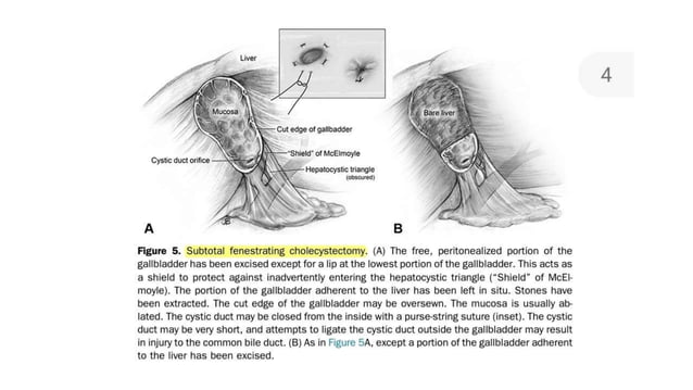 SAFE LAPAROSCOPIC CHOLECYSTECTOMY | PPTX | Digestive Disorders ...