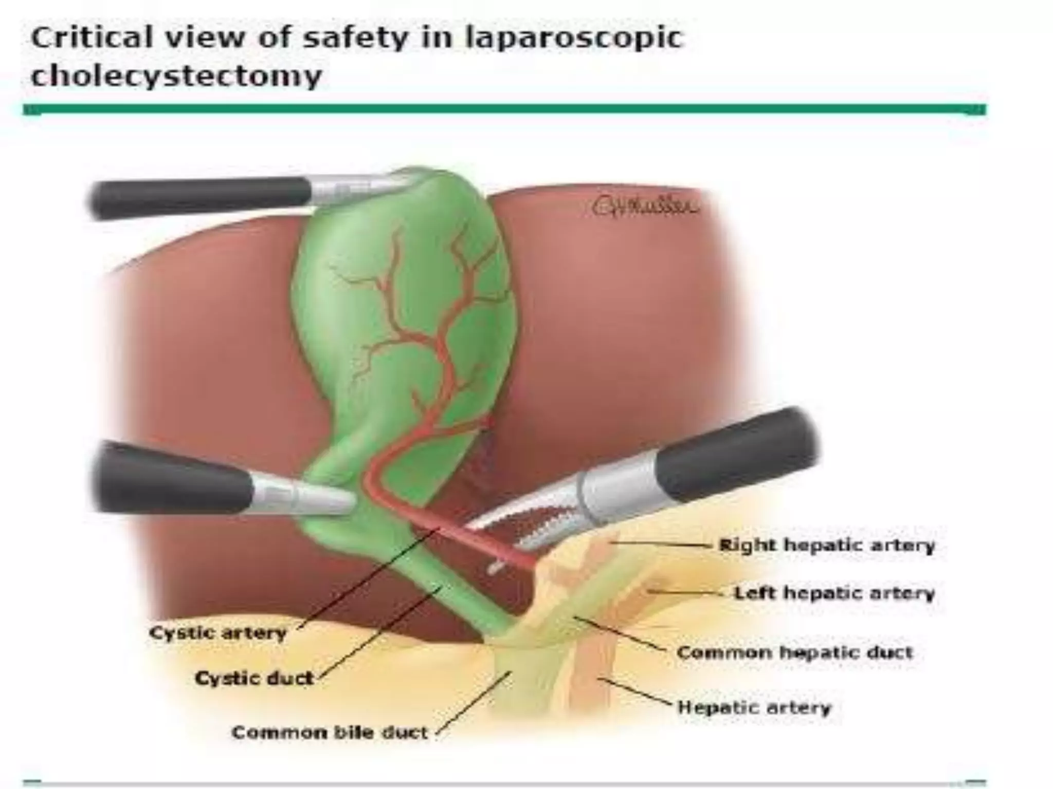 Safe laparoscopic cholecystectomy finale | PPTX