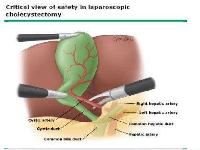 Safe Laparoscopic Cholecystectomy Finale