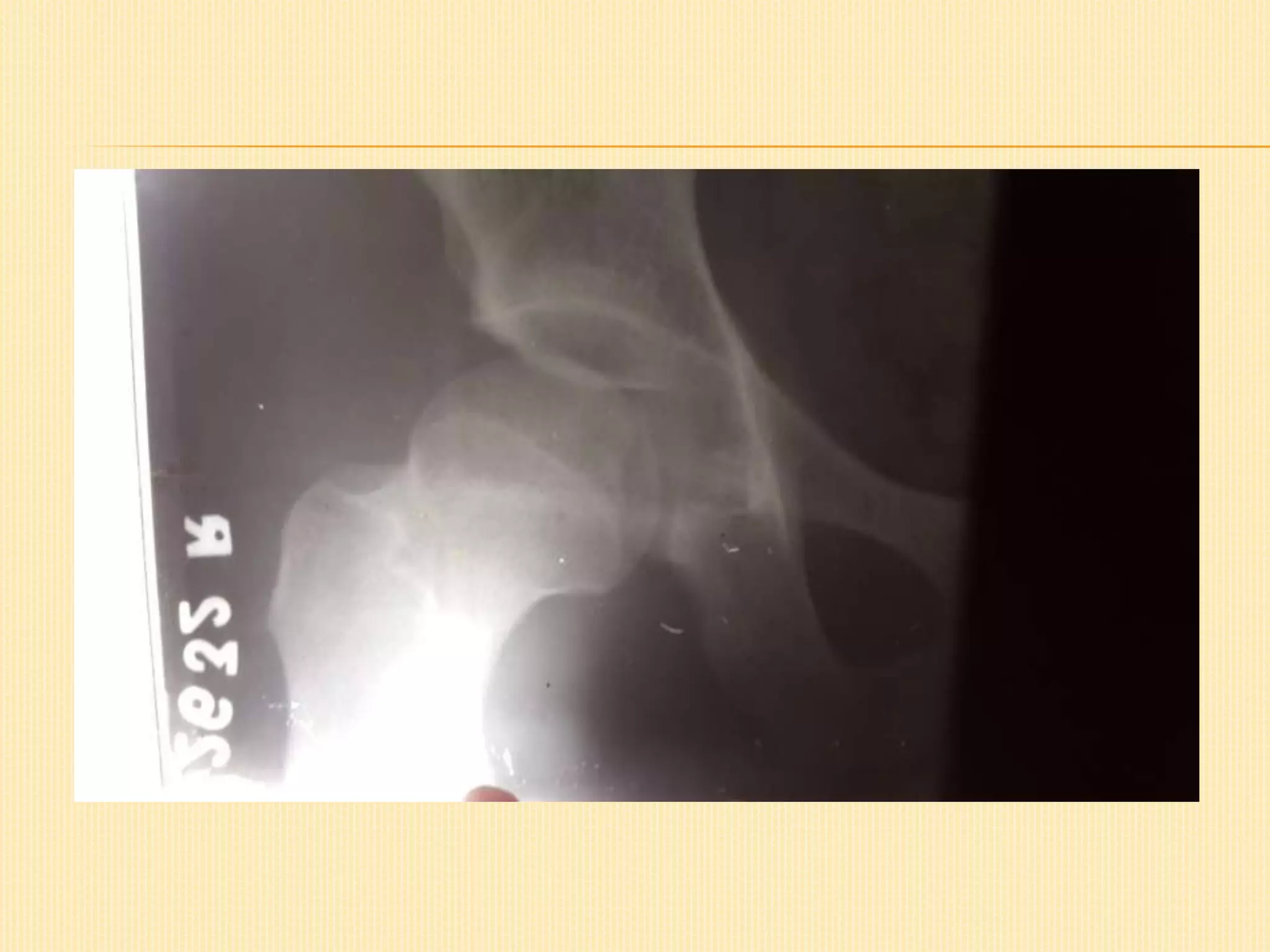 Safe Surgical Dislocation For Femoral Head Fracturesdr Mohamed Ashrafdr Rahul T Td
