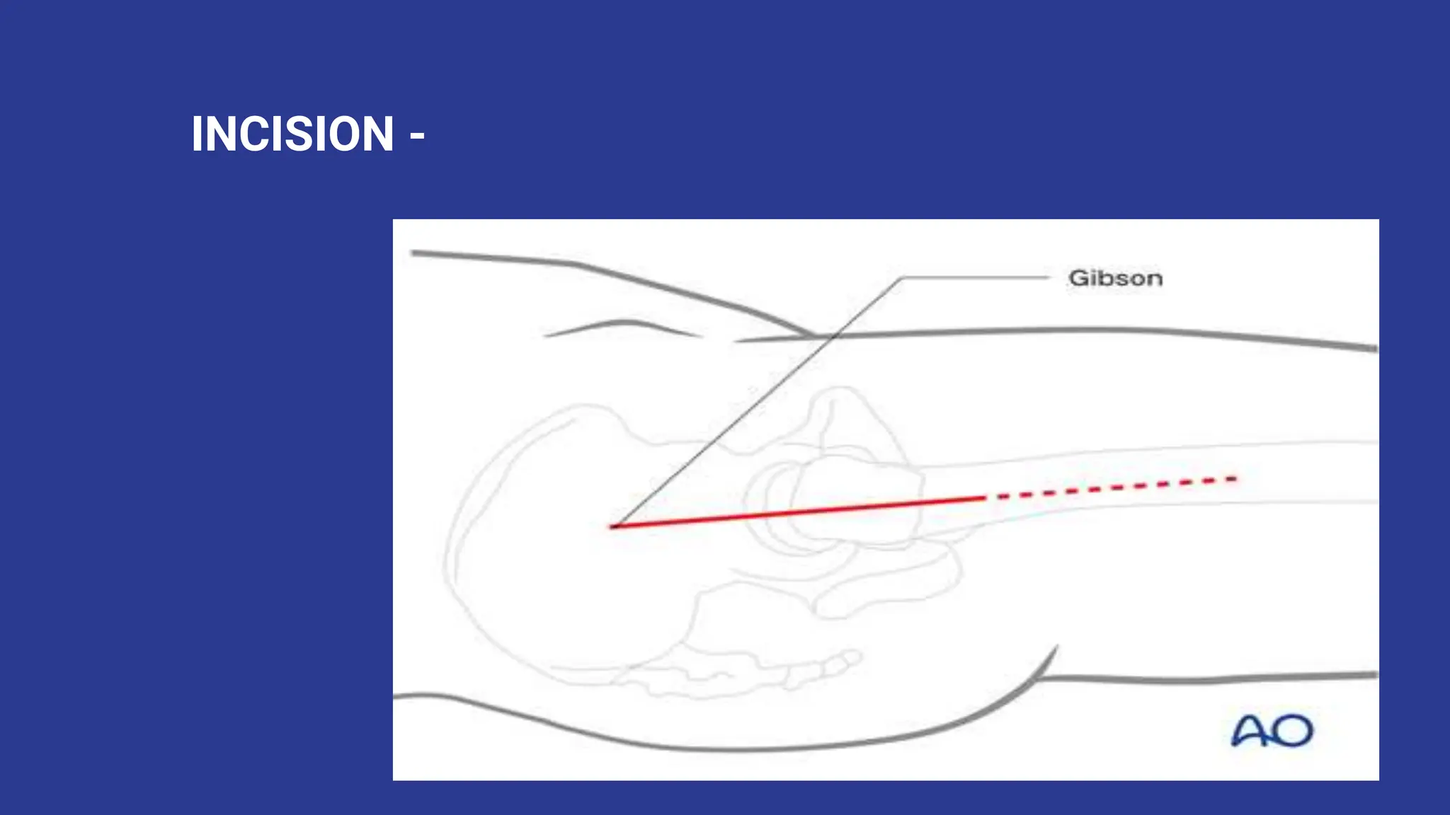 Safe Surgical Dislocation of Hip Joint.pptx