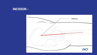 Safe Surgical Dislocation of Hip Joint.pptx