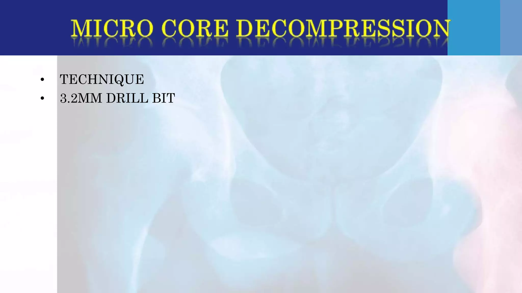 Safe surgical dislocation[ssd] for avascular necrosis hip[ avn] | PPTX