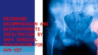 Safe surgical dislocation[ssd] for avascular necrosis hip[ avn] | PPTX