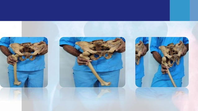 Safe surgical dislocation[ssd] for avascular necrosis hip[ avn] | PPTX ...