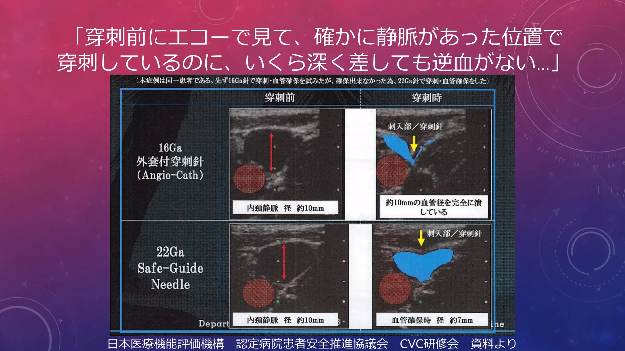 Safety management for cvc insertion | PDF