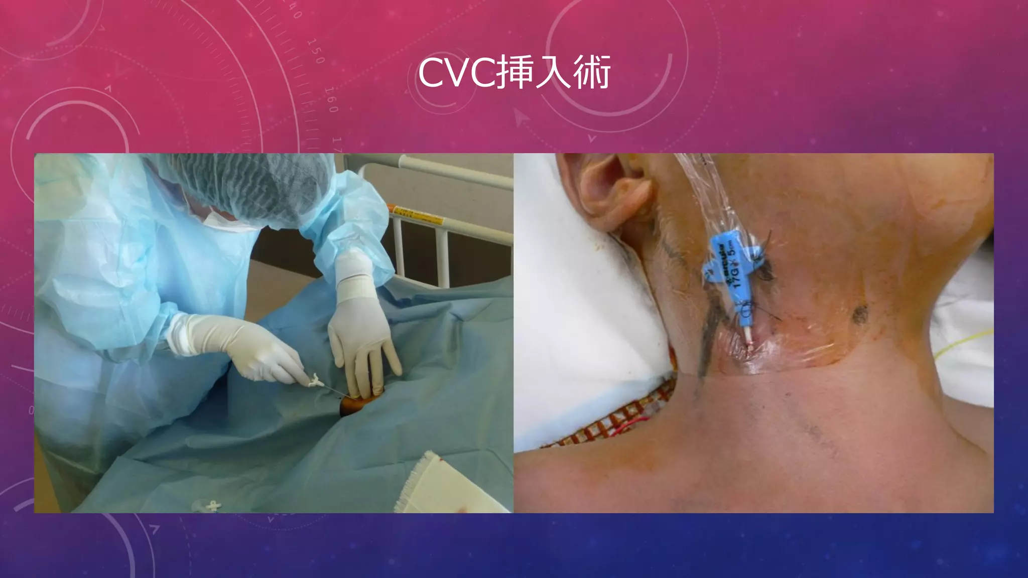 Safety management for cvc insertion | PDF