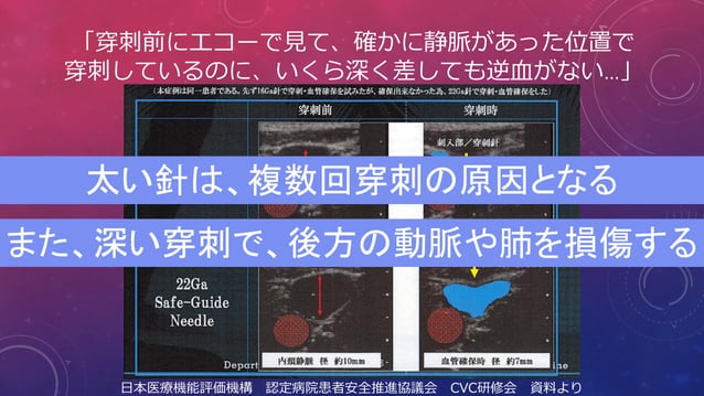 Safety management for cvc insertion | PDF | Medical Health