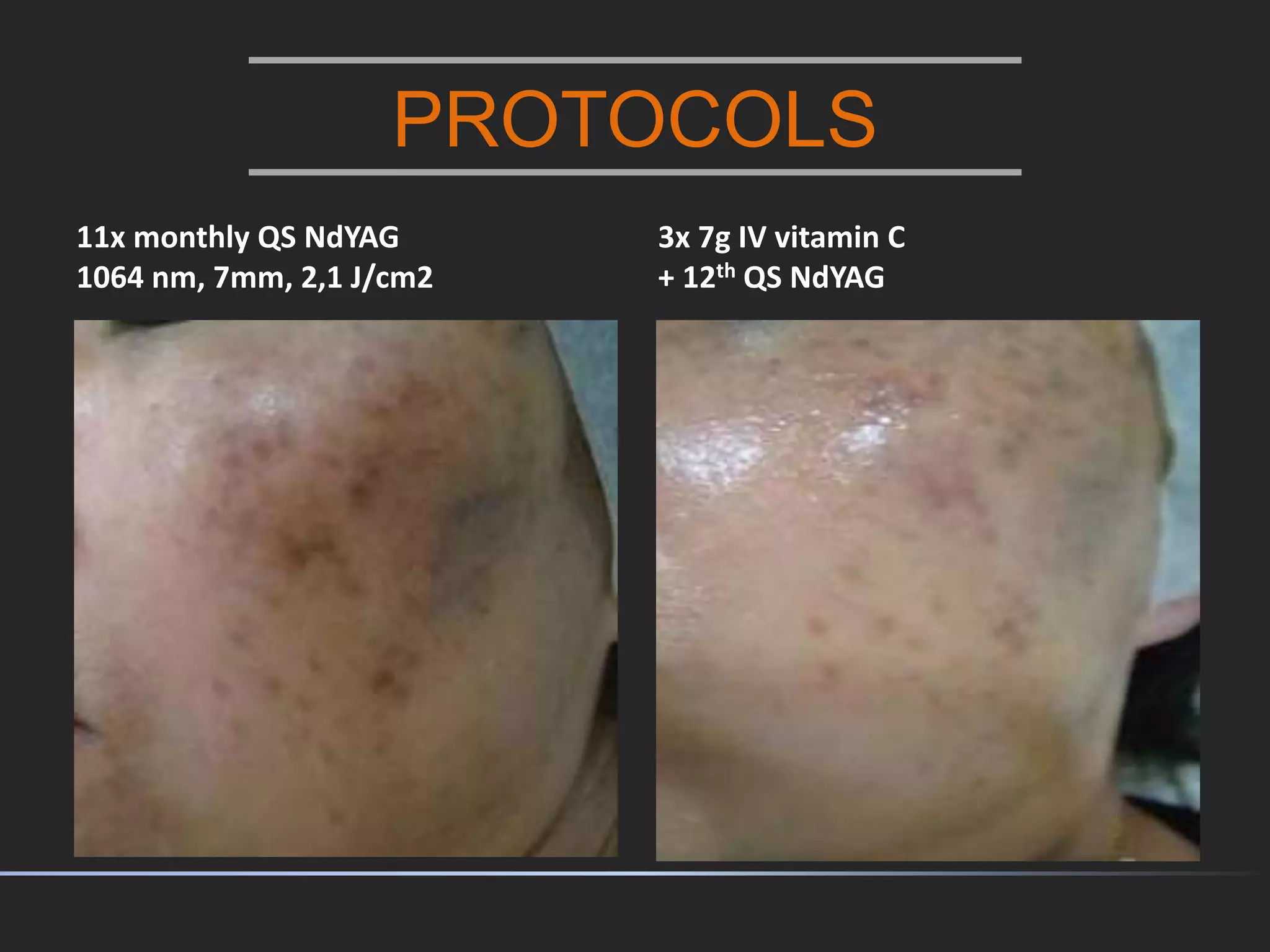 Safety protocol in vitamin c injection | PPTX | Blood Disorders ...