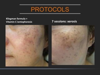 Safety protocol in vitamin c injection | PPTX | Blood Disorders ...