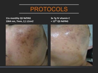 Safety protocol in vitamin c injection | PPTX | Blood Disorders ...