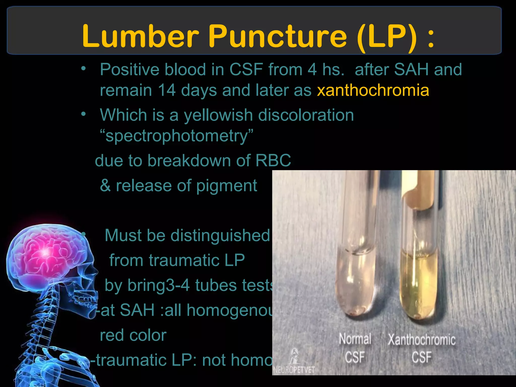 Subarachnoid hemorrhage | PPT