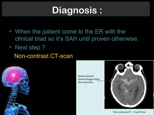 Subarachnoid hemorrhage | PPT