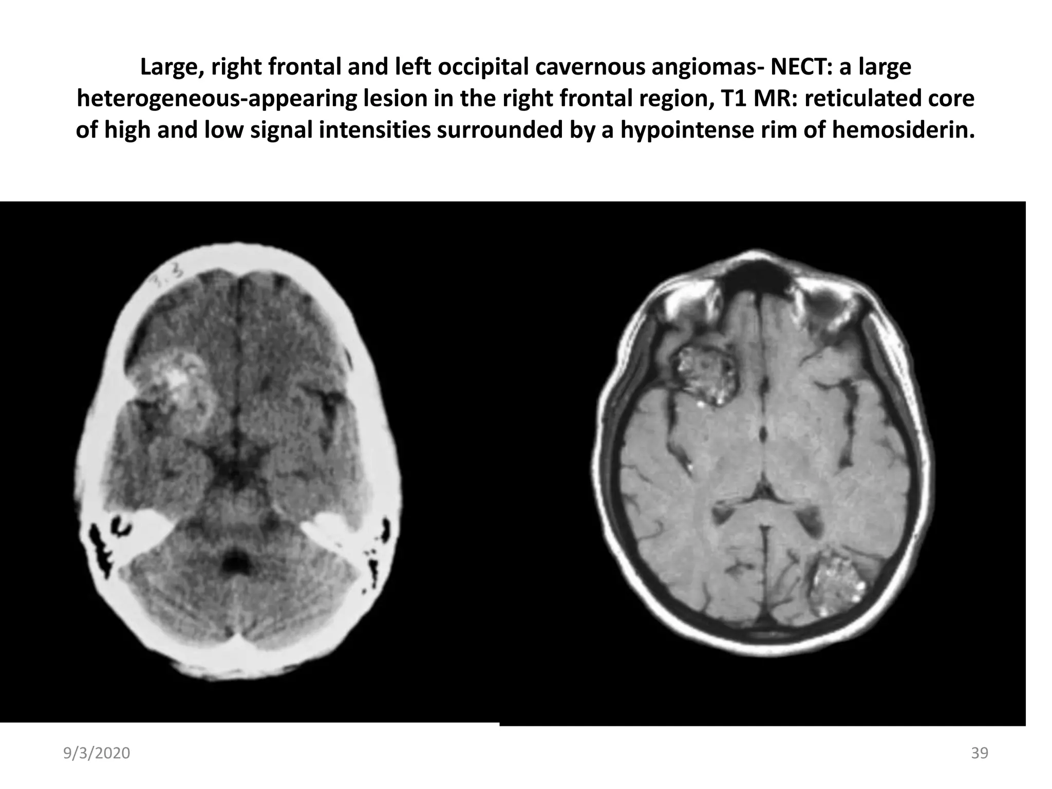 Non traumatic Subarachnoid hemorrhage (SAH) | PPTX