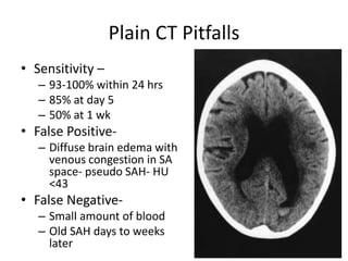 Non traumatic Subarachnoid hemorrhage (SAH) | PPTX