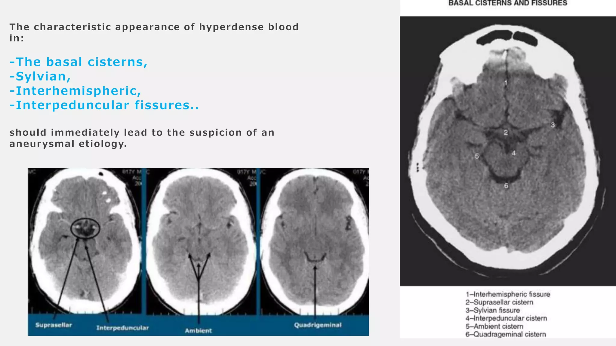 Subarachnoid hemorrhage | PPTX