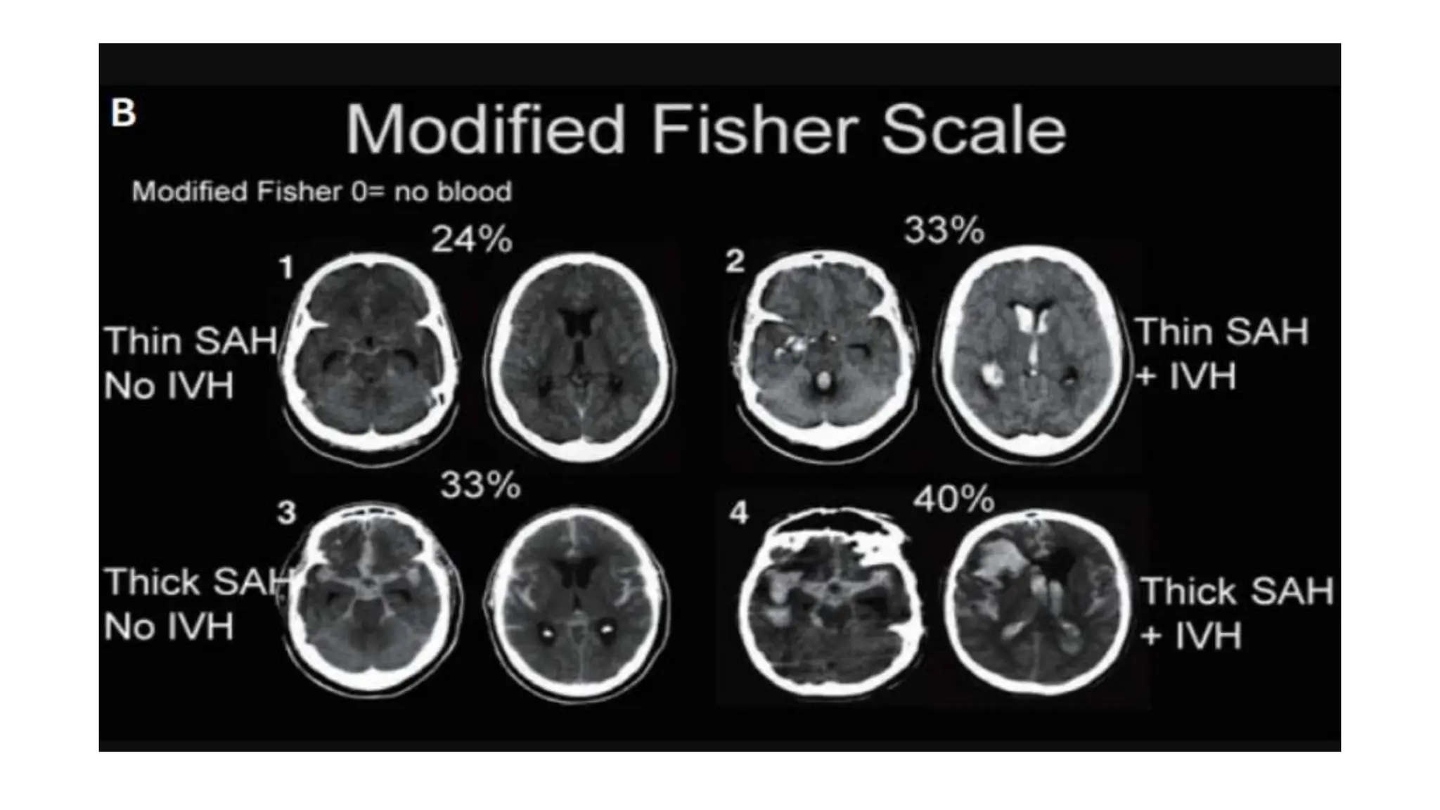 Subarachnoid hemorrhage in brain. .pptx
