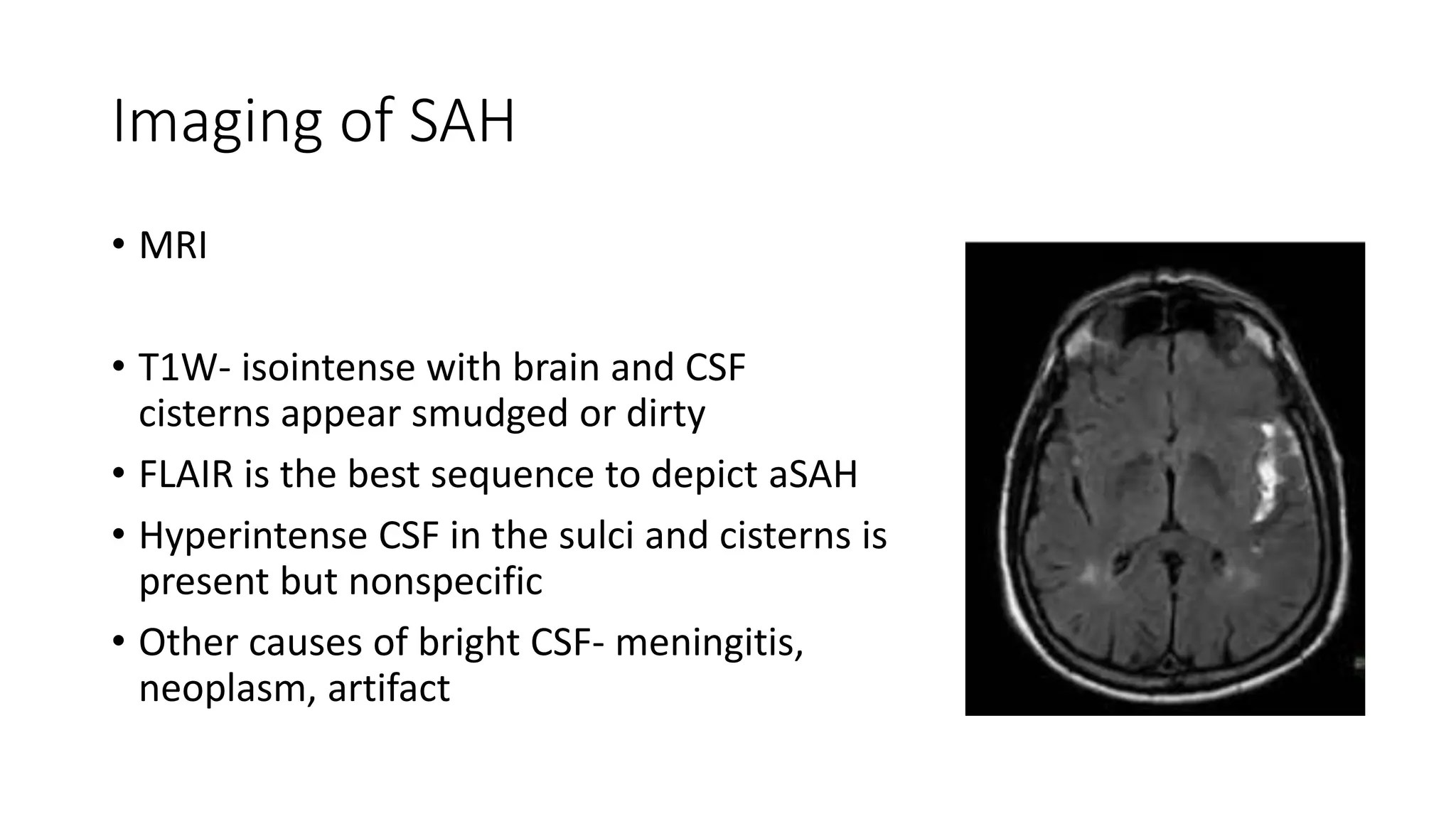 Subarachnoid hemorrhage in brain. .pptx