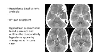 Subarachnoid hemorrhage in brain. .pptx