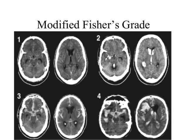 SAH for Neurology Residents