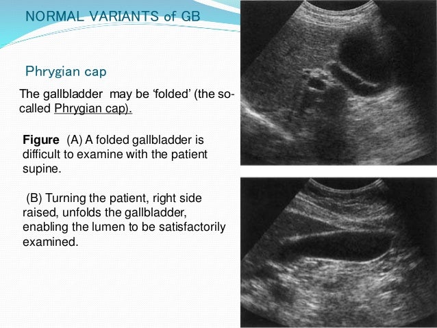Gallbladder Infundibulum