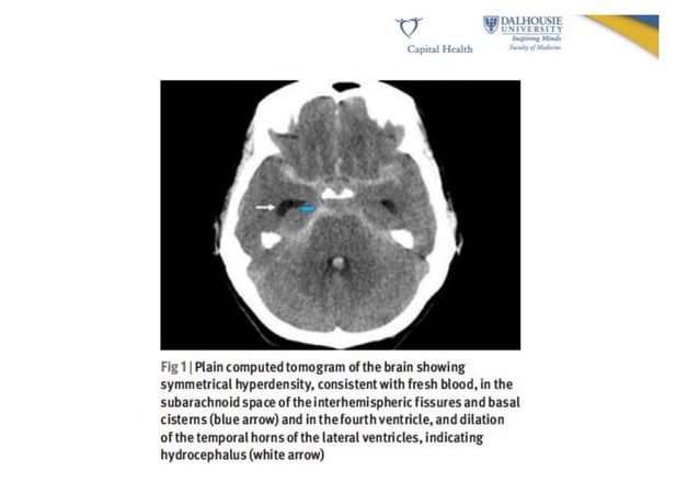 Subarachnoid hemorrhage and Vasospasm | PDF