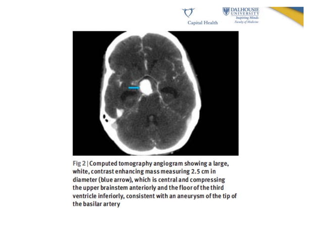Subarachnoid hemorrhage and Vasospasm | PDF