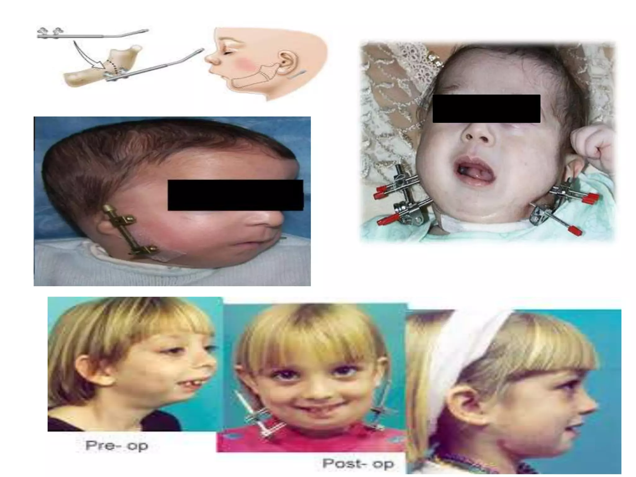 Pierre Robin Syndrome | PPTX | Ear, Nose and Throat Conditions ...