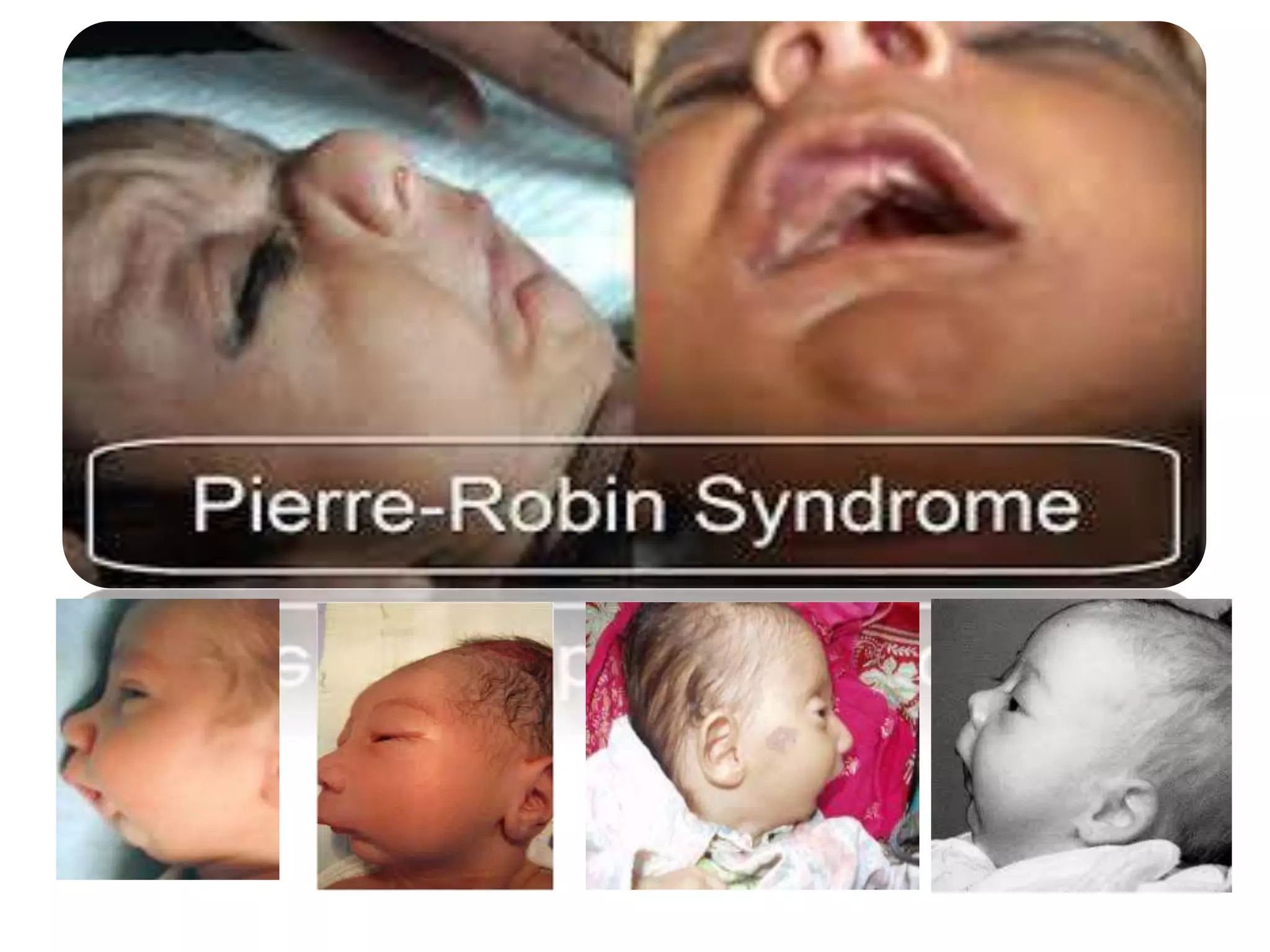 Pierre Robin Syndrome | PPTX