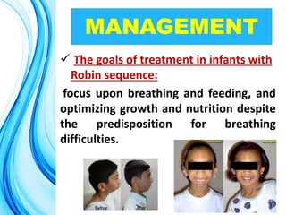 Pierre Robin Syndrome | PPTX