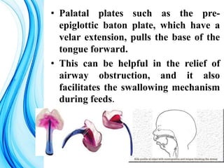 Pierre Robin Syndrome | PPTX