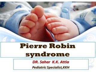 Pierre Robin Syndrome | PPTX